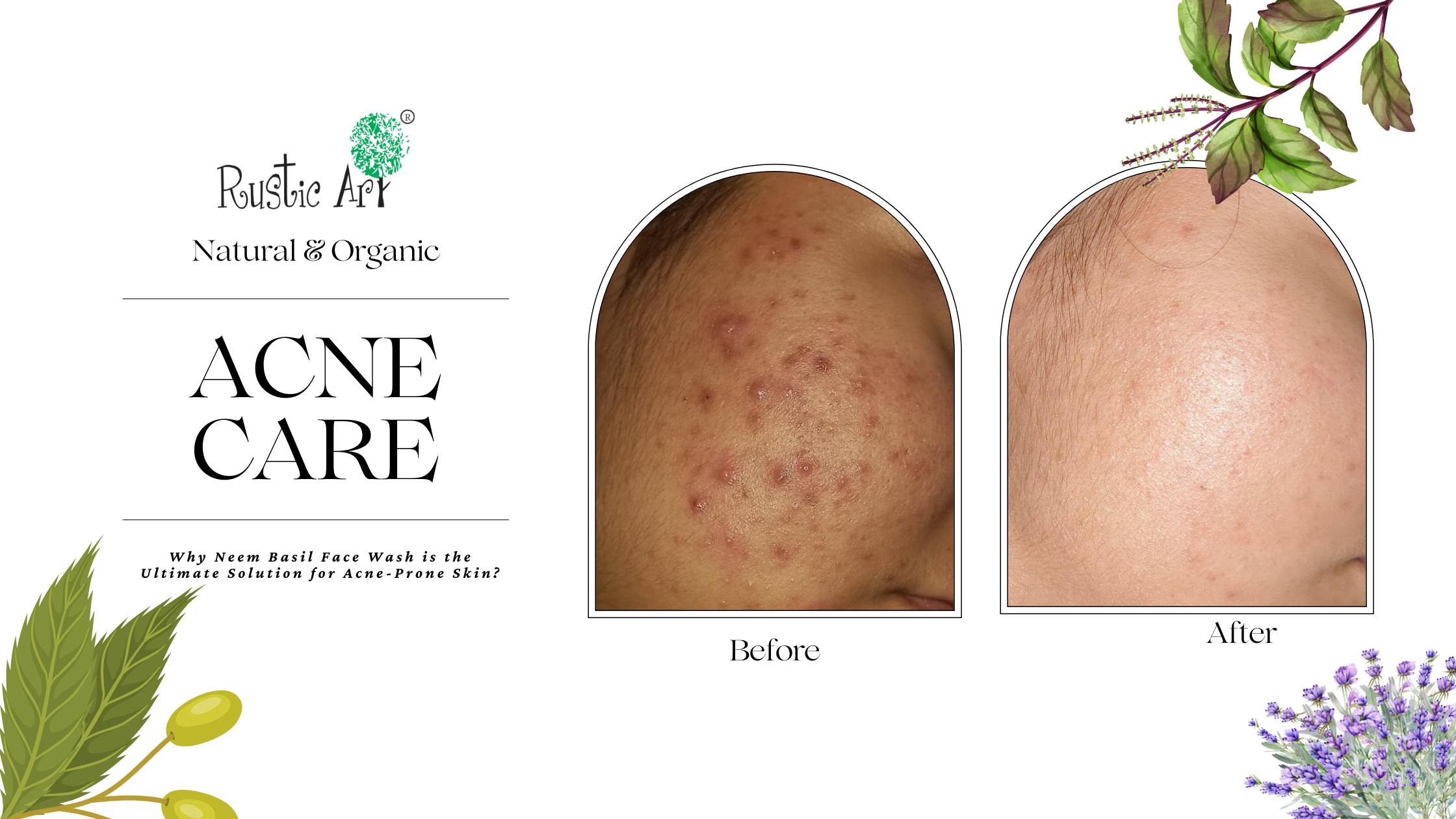 Why Neem Basil Face Wash is the Ultimate Solution for Acne-Prone Skin ...